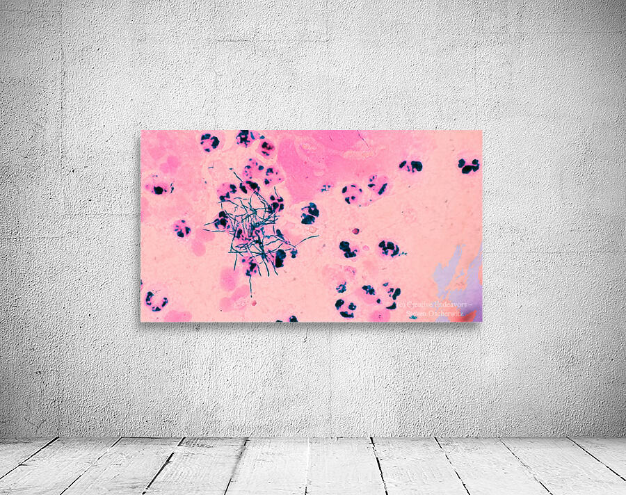 Colorized Nocardia organisms with white blood cel by Creative Endeavors ...